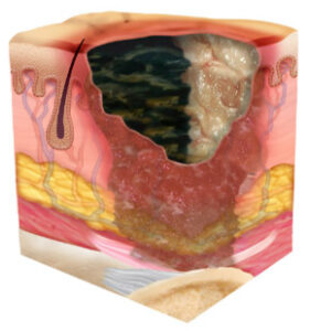 Pressure Injury Staging Guide and Kit | 4 Key Pressure Ulcer Stages ...